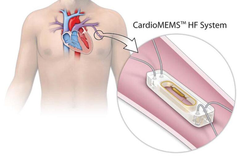 Revolutionizing Heart Failure Management: The CardioMEMS System - Tri ...