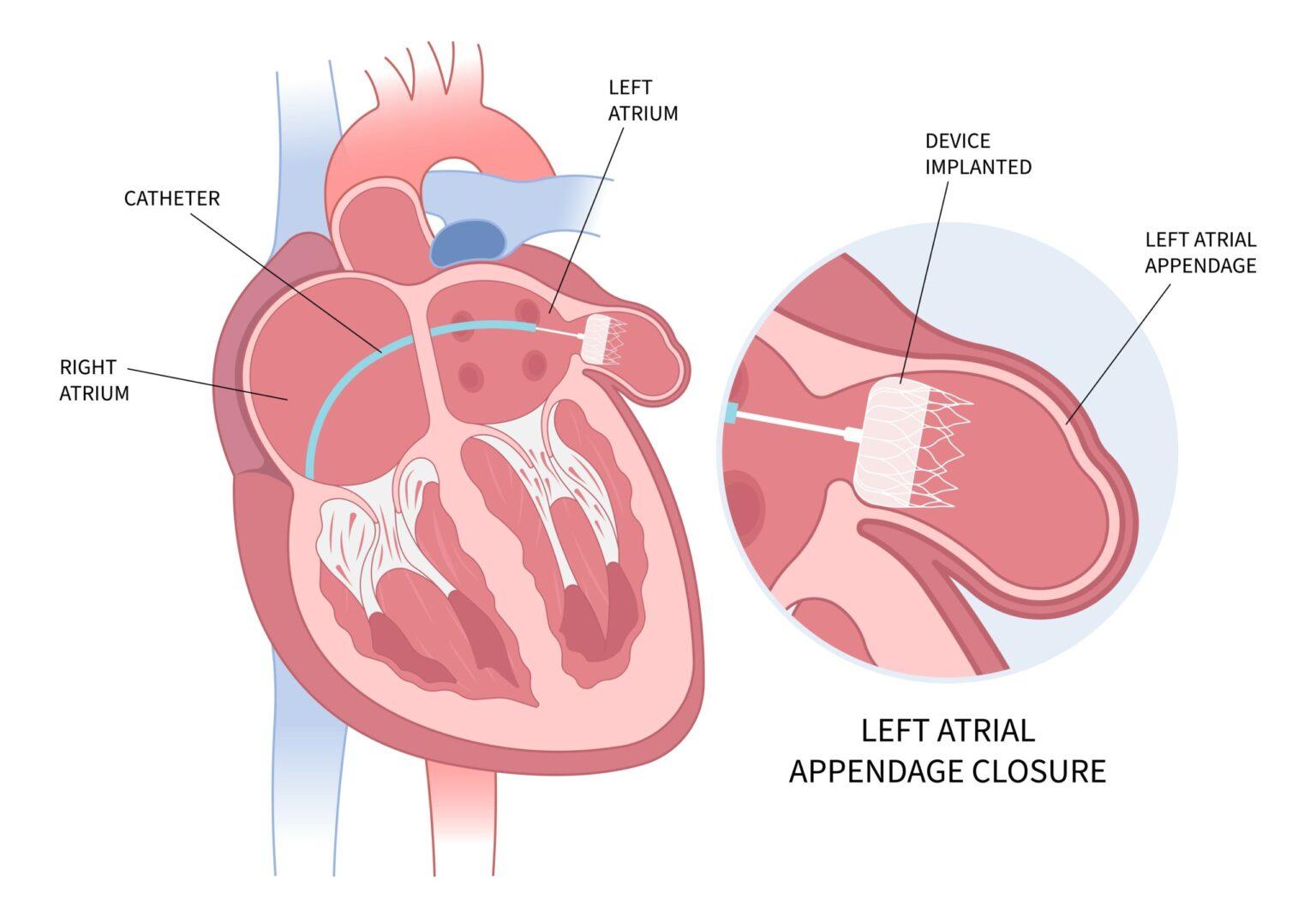 The WATCHMAN FLX Pro Device: A Revolutionary Solution in Cardiology ...