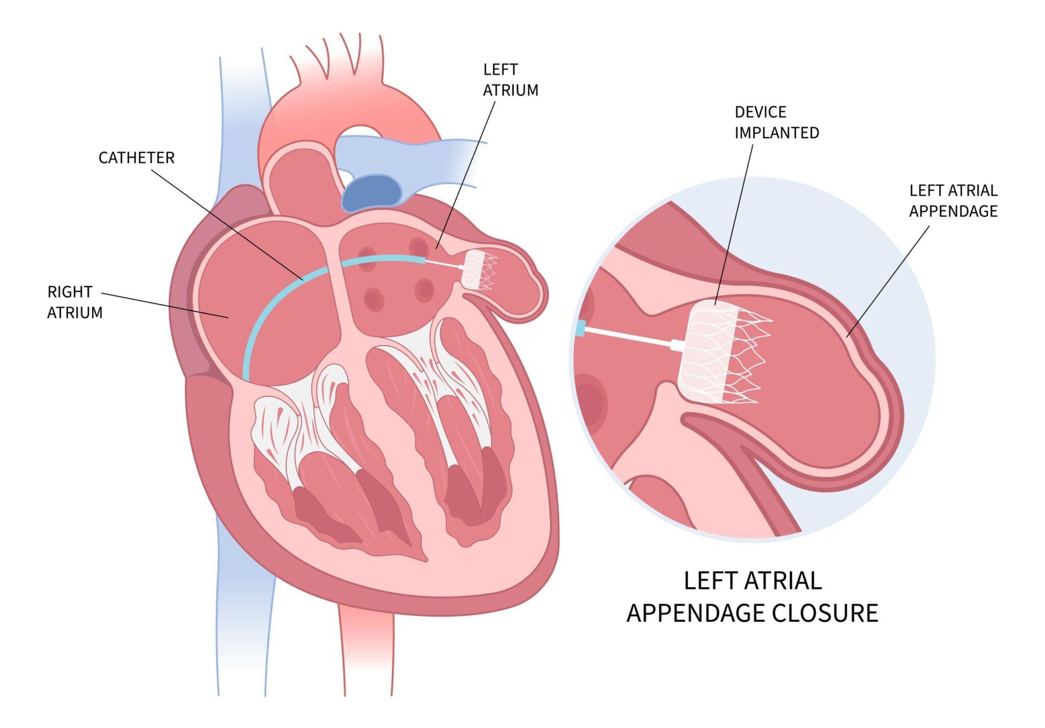 The WATCHMAN FLX Pro Device: A Revolutionary Solution in Cardiology ...