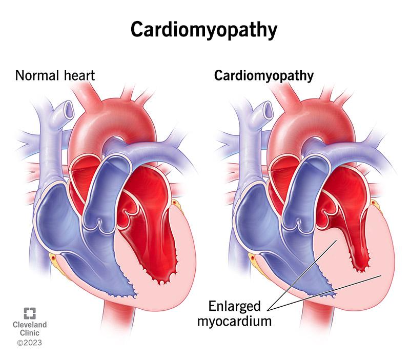 Understanding Cardiomyopathy: A Comprehensive Overview - Tri City ...